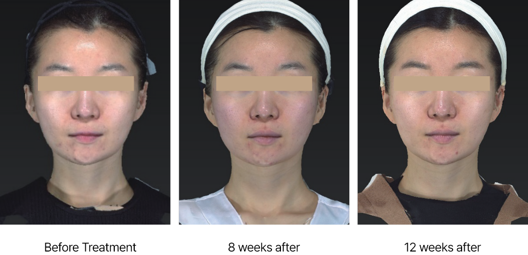 VOLNEWMER – Patients – CLASSYS