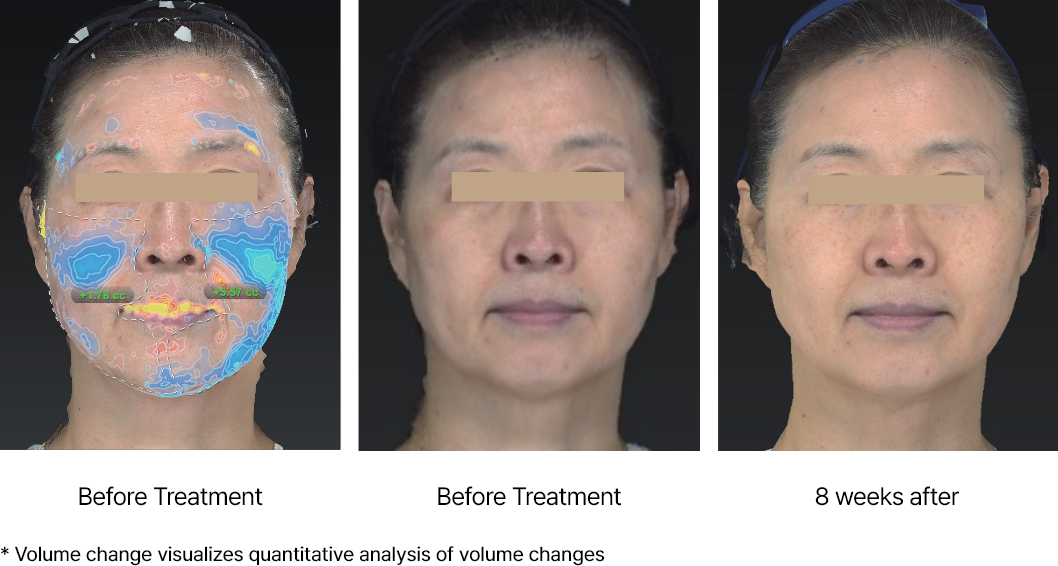 VOLNEWMER – Patients – CLASSYS